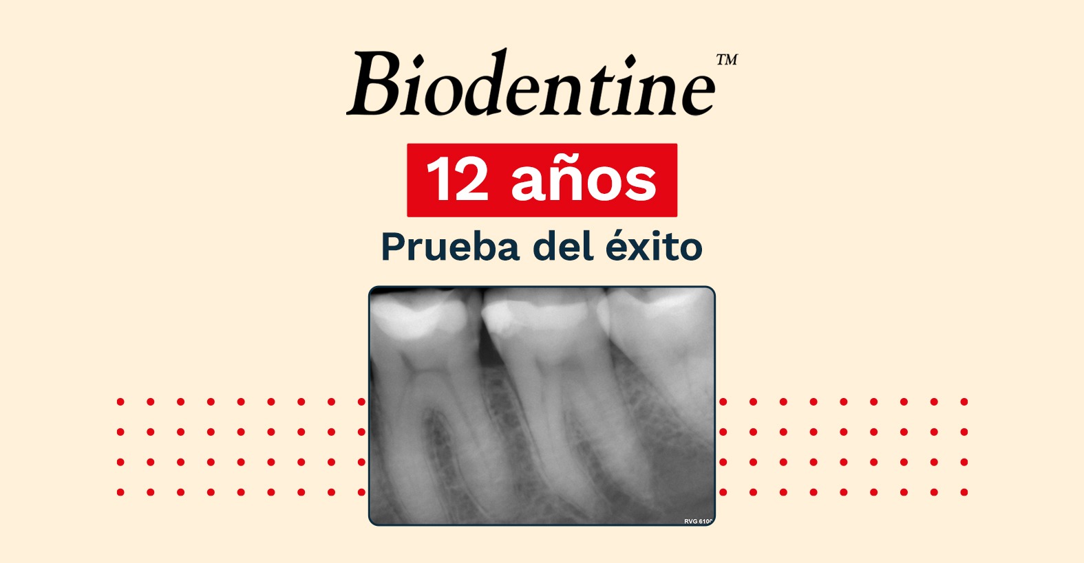 Recubrimiento Pulpar Indirecto - Dr Sabbagh - Septodont España