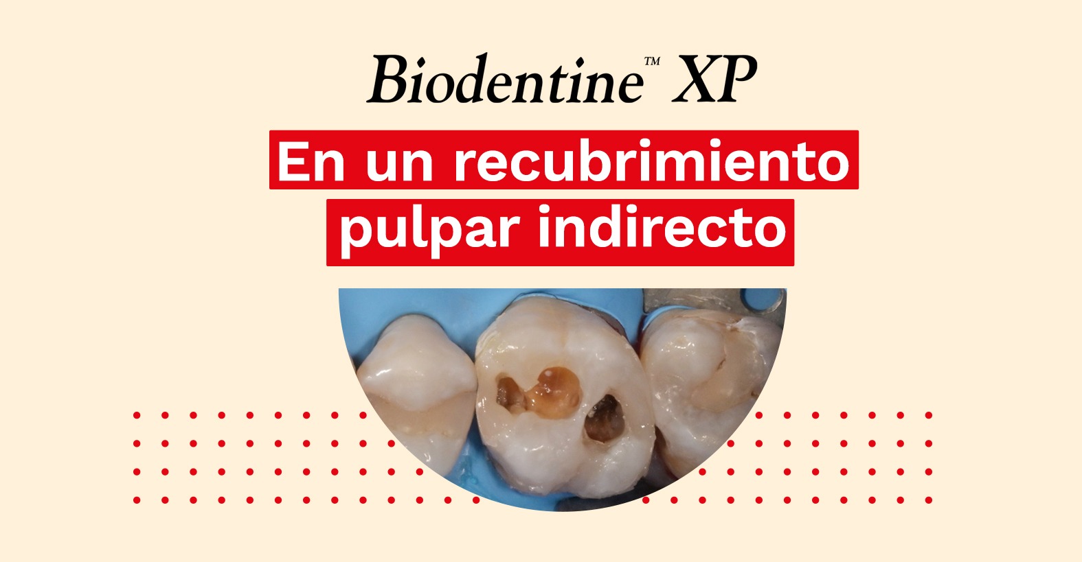 Recubrimiento Pulpar Indirecto – Dr Ganowicz - Septodont España