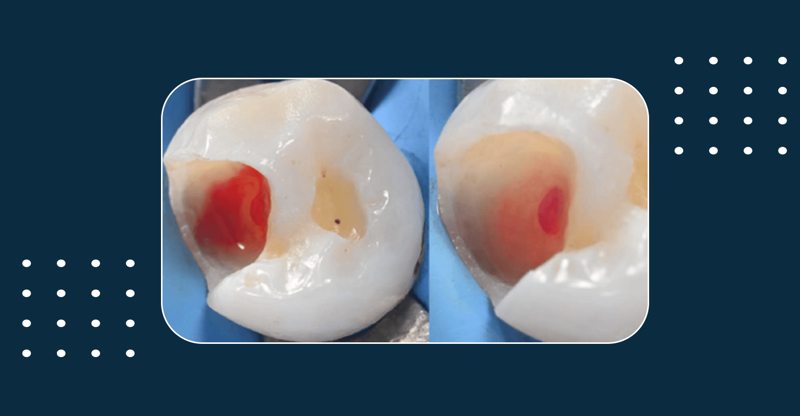 CASE STUDY: Recubrimiento pulpar directo con la técnica BioBulk Fill - Septodont España
